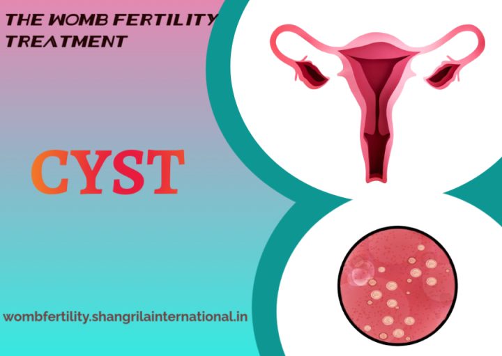Types Of Cyst – The Womb Fertility Treatment
