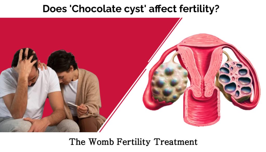 How chocolate cyst affects fertility? – The Womb Fertility Treatment