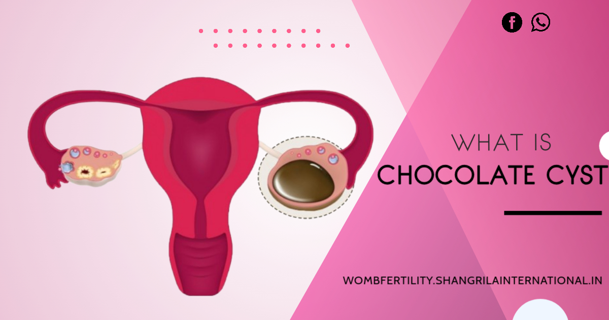 Is ‘Chocolate Cyst’ a threat? – The Womb Fertility Treatment